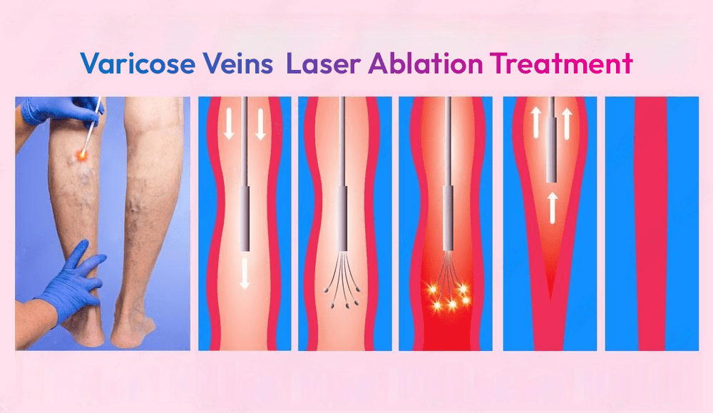 Varicose Veins Treatment: Laser Ablation vs. Glue – Which is Best?